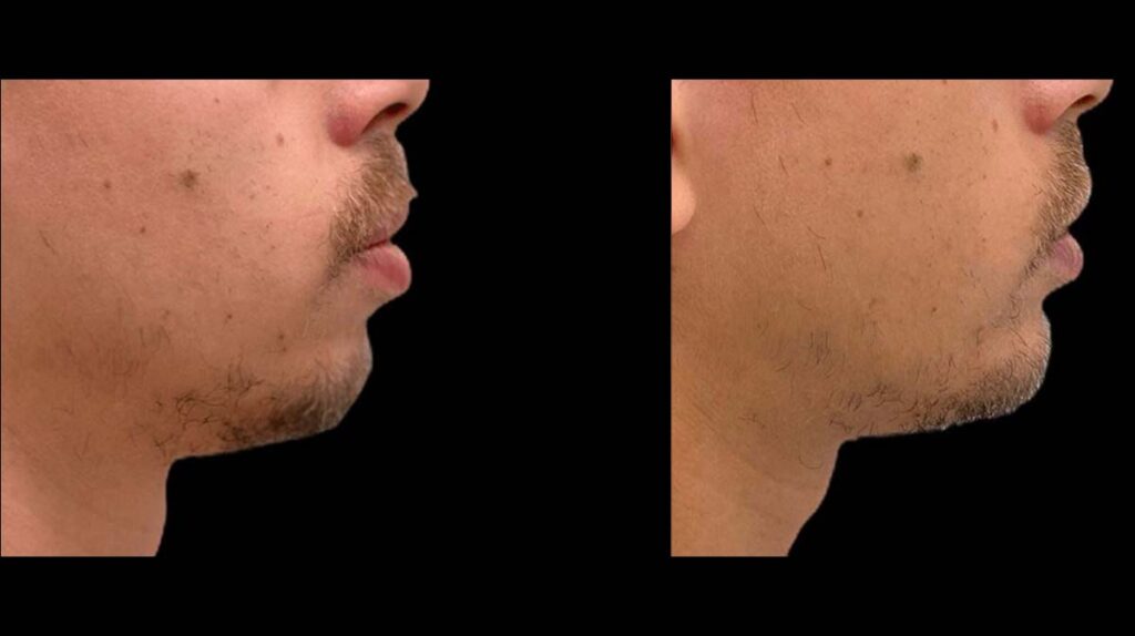 Chin Augmentation Before & Afters - Inspire Aesthetics