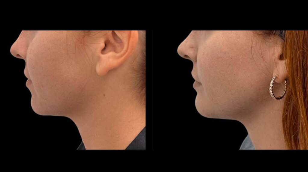 Chin Augmentation Before & Afters - Inspire Aesthetics
